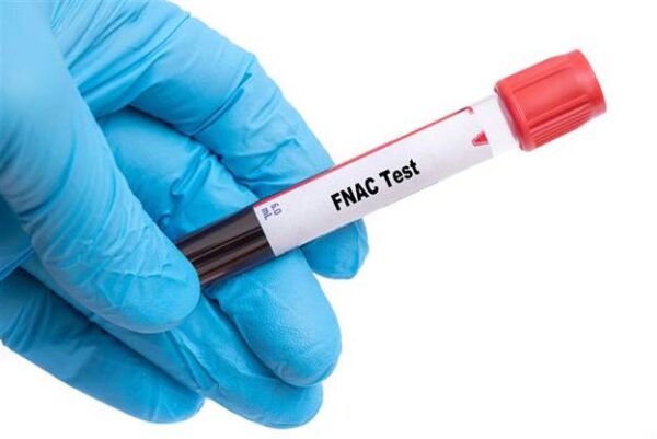 Understanding the FNAC Test: What It Is and Why It Matters - Sm Path ...